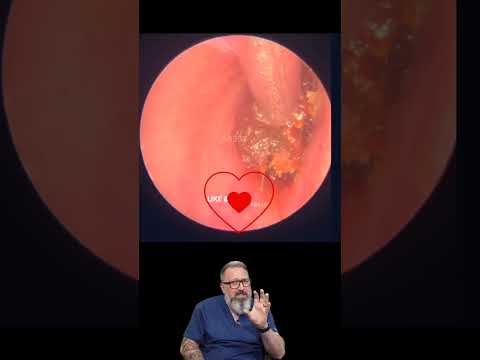 REMOVING THE DEEPEST EAR WAX PLUG - EP983