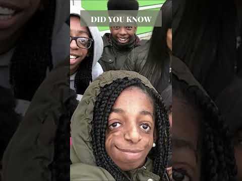 Shocking Reality of Treacher Collins Syndrome #shorts