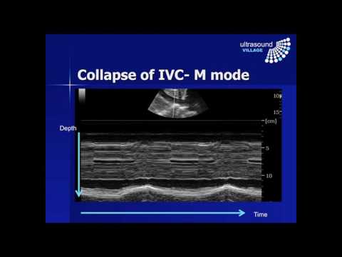 Hyovolaemia
