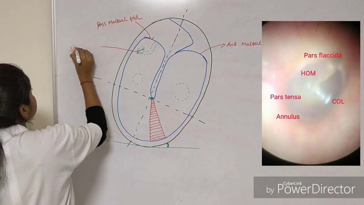 Normal Tympanic Membrane
