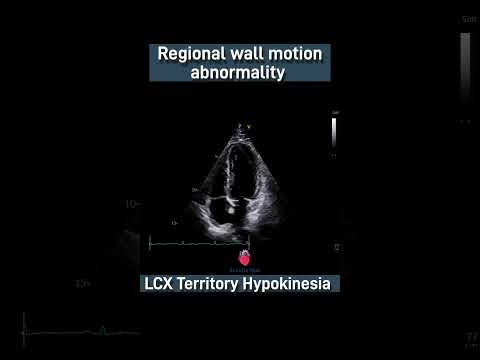 LCX Territory β Hypokinesia on Echocardiography #echocardiography #2decho #echoeducation