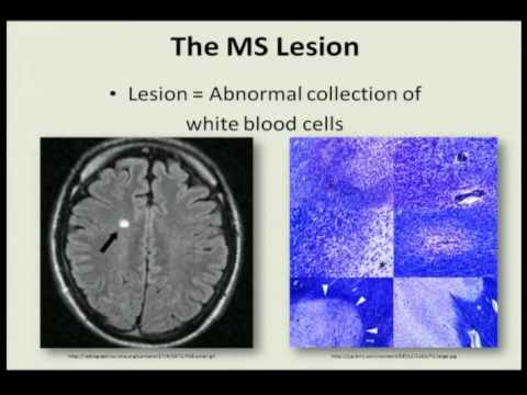 MS: Back to Basics - Michelle Fabian, MD - Changing the Future MS Patient Symposium 2012