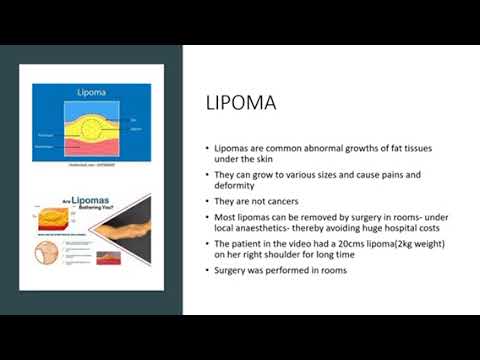 Lipoma surgery