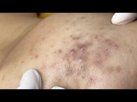 Treating Teen Acne | Điều Trị Mụn Cho Bạn Nam Tuổi Dậy Thì - SacDepSpa#316