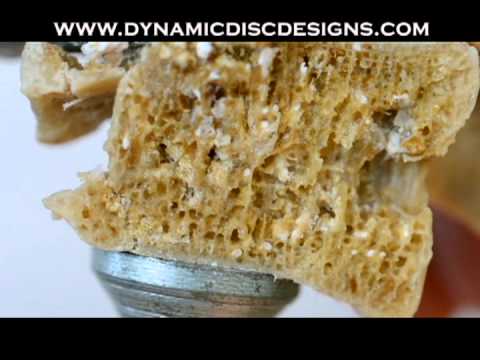 Spinal Compression Fracture by Dynamic Disc Designs Corp.