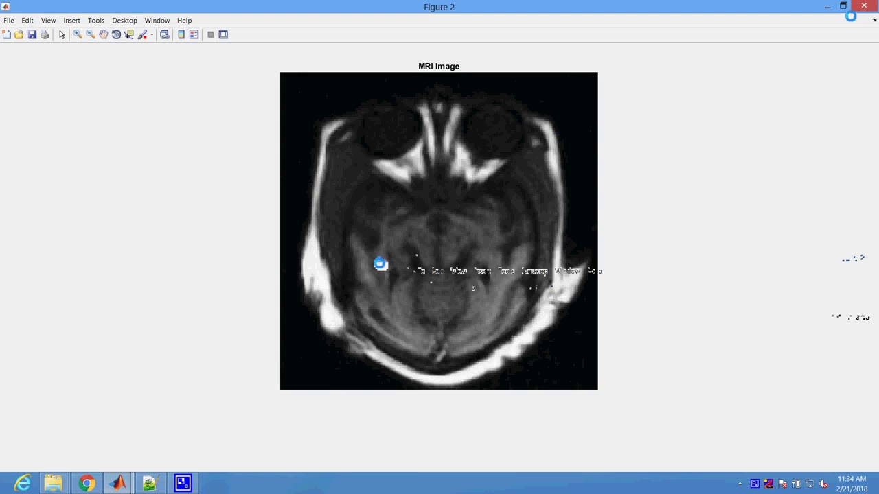 An Enhancement In Detection Of Brain Cancer in Matlab - OKOK PROJECTS ...