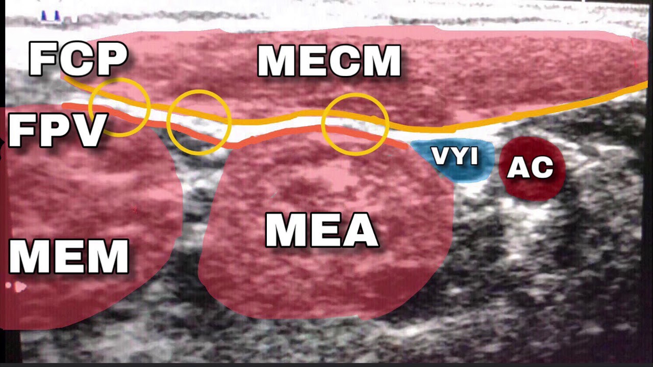 Ultrasound-guided superficial cervical plexus block