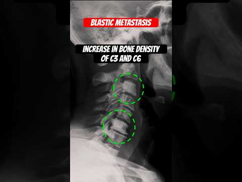Metastatic spread of Cancer to the Spine #shorts #medical #doctor