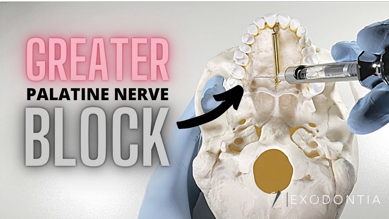 GREATER PALATINE NERVE BLOCK | OnlineExodontia.com