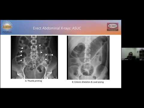 G-ECHO Fellows Presentation : Acute severe UC