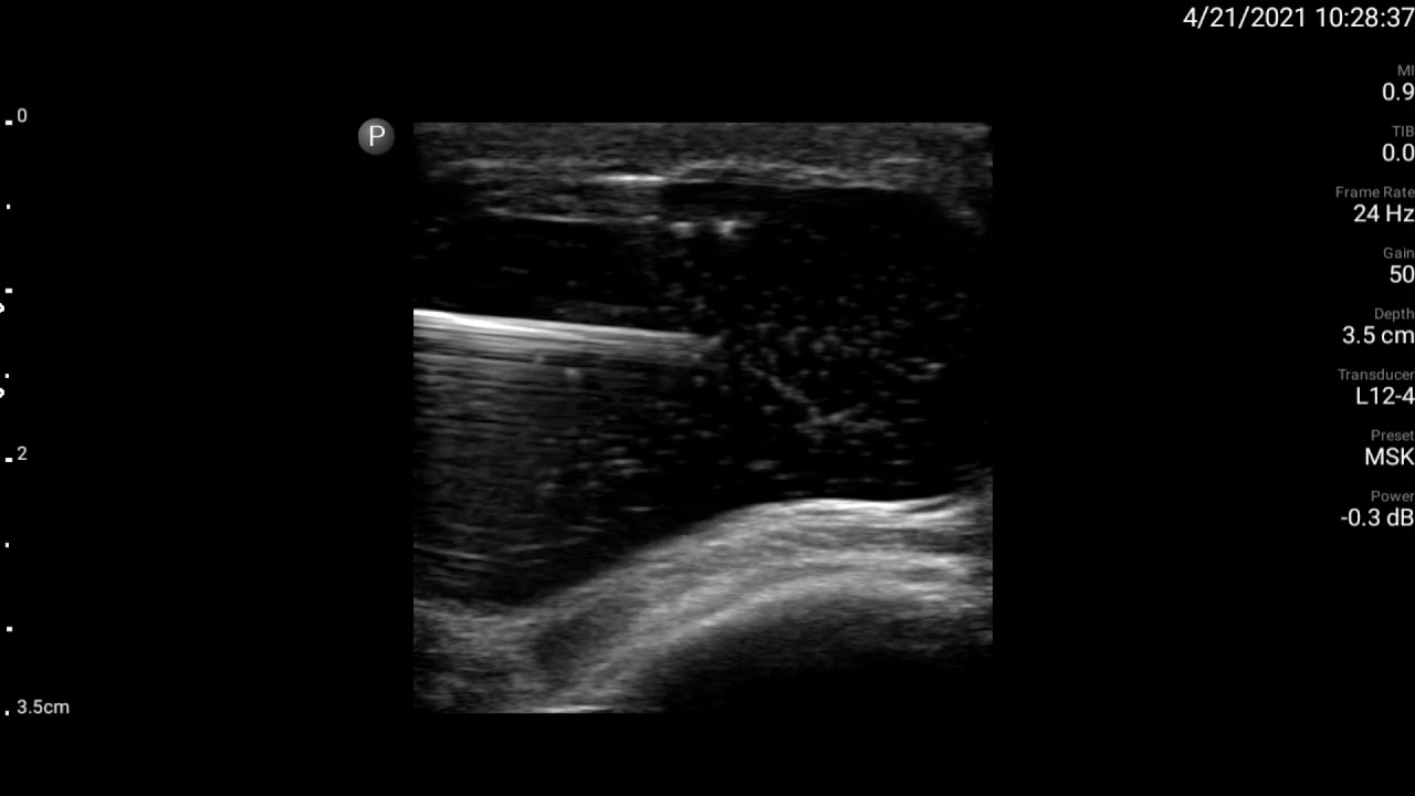 Knee Ultrasound: Prepatellar Bursa Injection (Part 2)