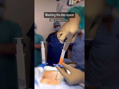 Draining pus from spine 😨