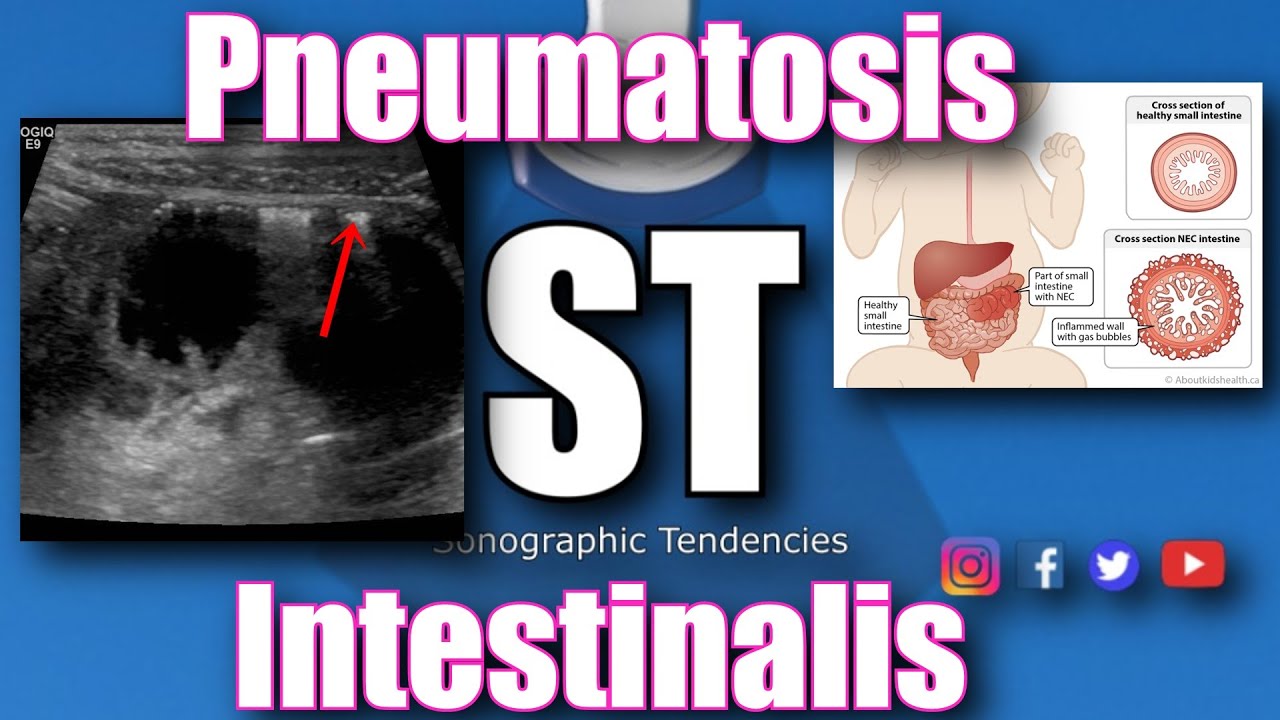 Pneumatosis Intestinalis