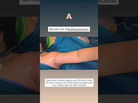 Arm Liposuction Procedure #beforeandafter #liposuction #shorts