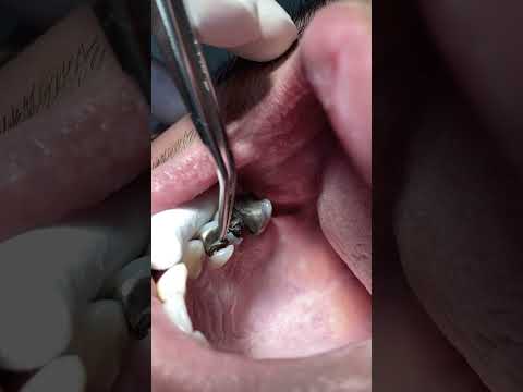 Root canal treatment without crown 🥲 #short
