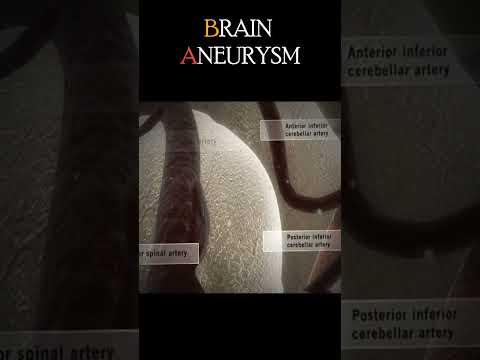 Brain Aneurysm #shorts