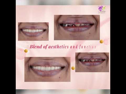 Immediate Implants| Rehabilitation| We Dental| Dr Arshad| Pride of Coimbatore| Dentistry| Coimbatore