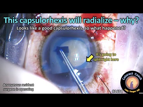 CataractCoach 1654: this capsule will radialize - why?