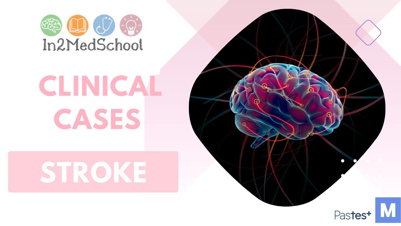 Stroke Clinical Case