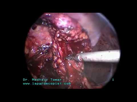 Lap Nephrectomy Rt