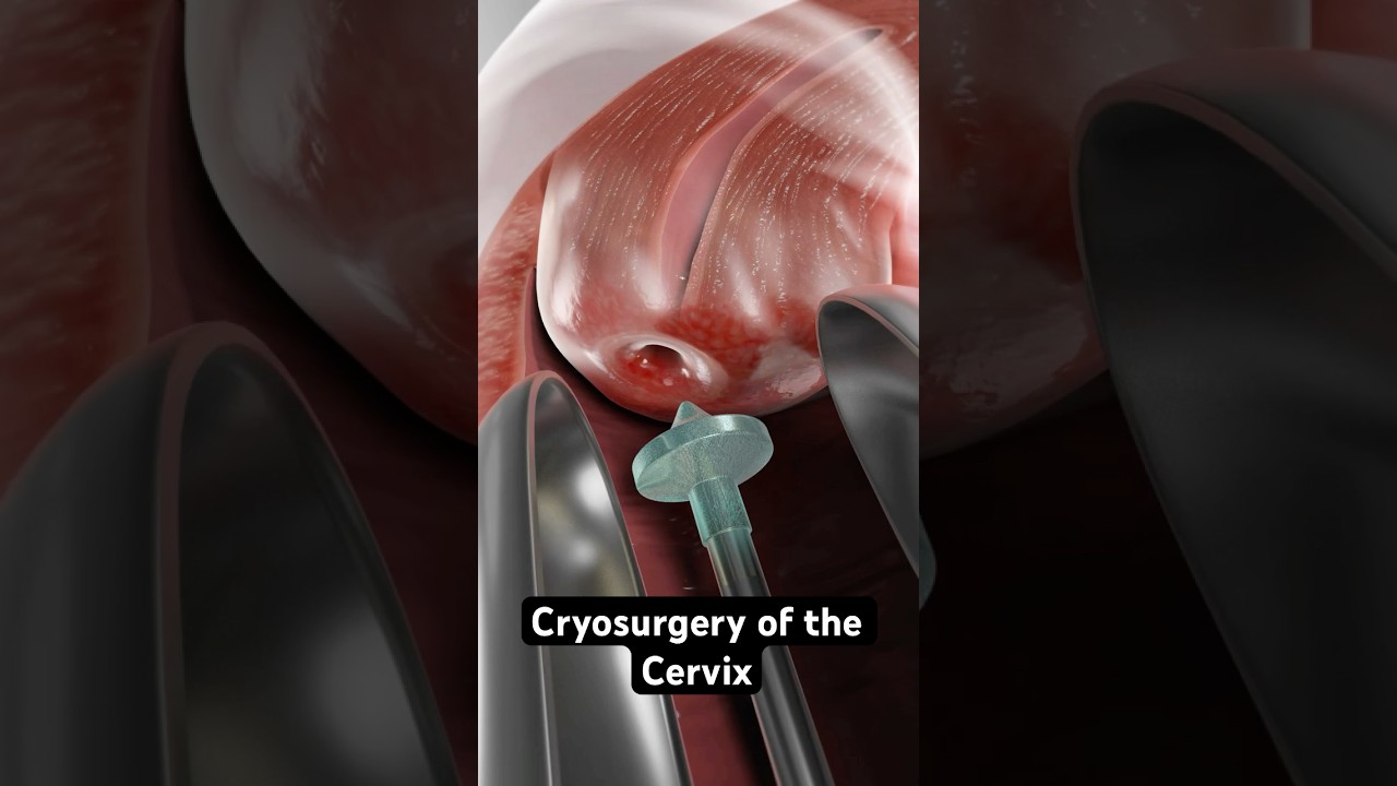 Freezing abnormal cells to prevent cervical cancer (3D Animation)