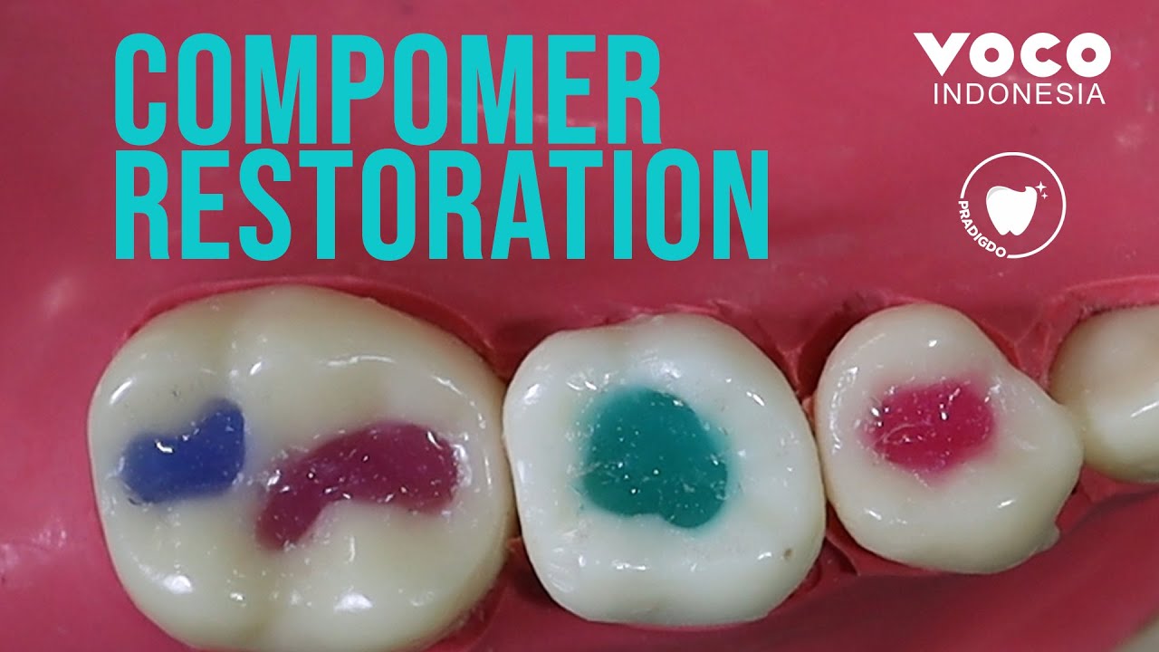 Compomer Restoration, Pediatric Restorative |Twinky Star - VOCO GmbH