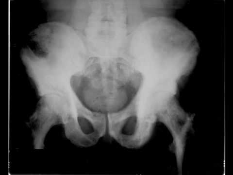 Paget's Disease