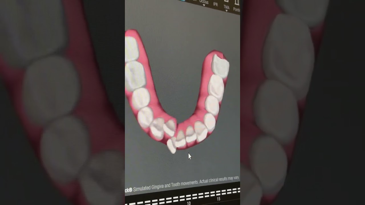 Invisalign Before & After | Gentle Dentistry of Poway Smile Transformation