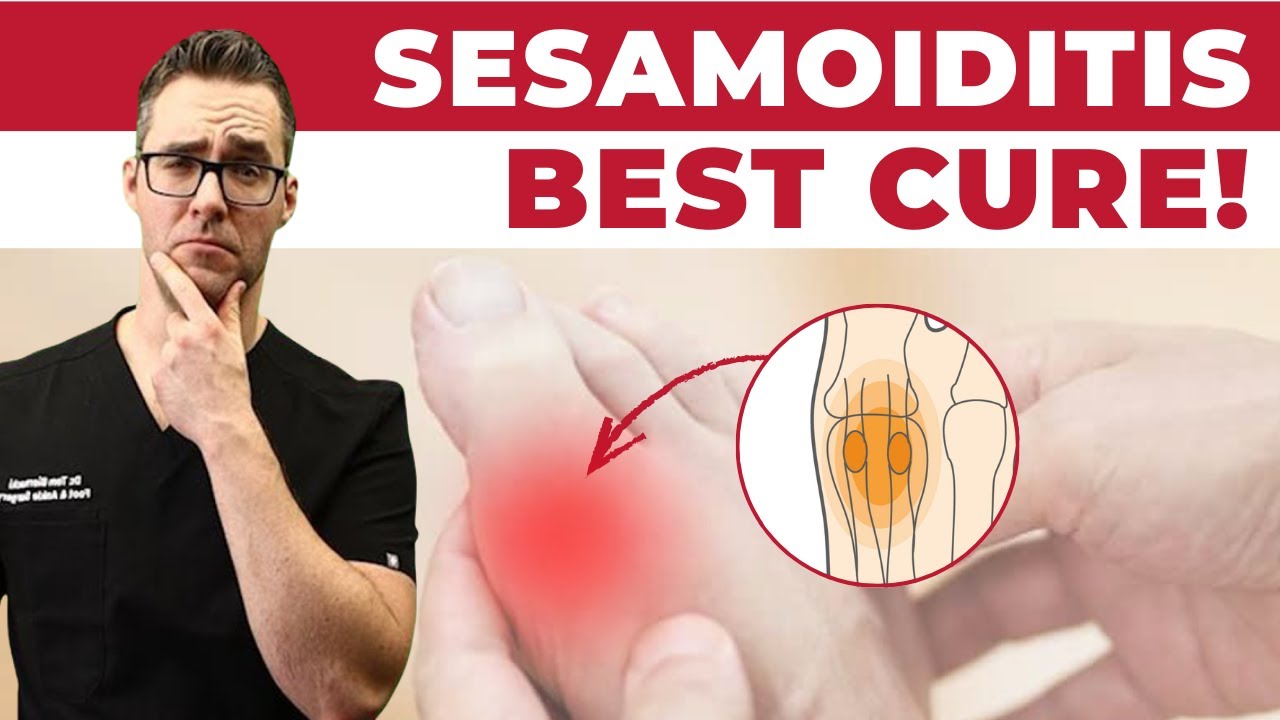 BEST Sesamoiditis Treatment [Big Toe Joint Pain & Big Toe Treatment]