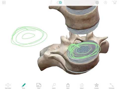 Disc Herniation - What is a Disc Protrusion vs Disc Extrusion?
