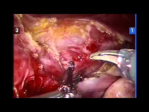 DaVinci robotic assisted resection of dense bladder adhesions (with voice narration).