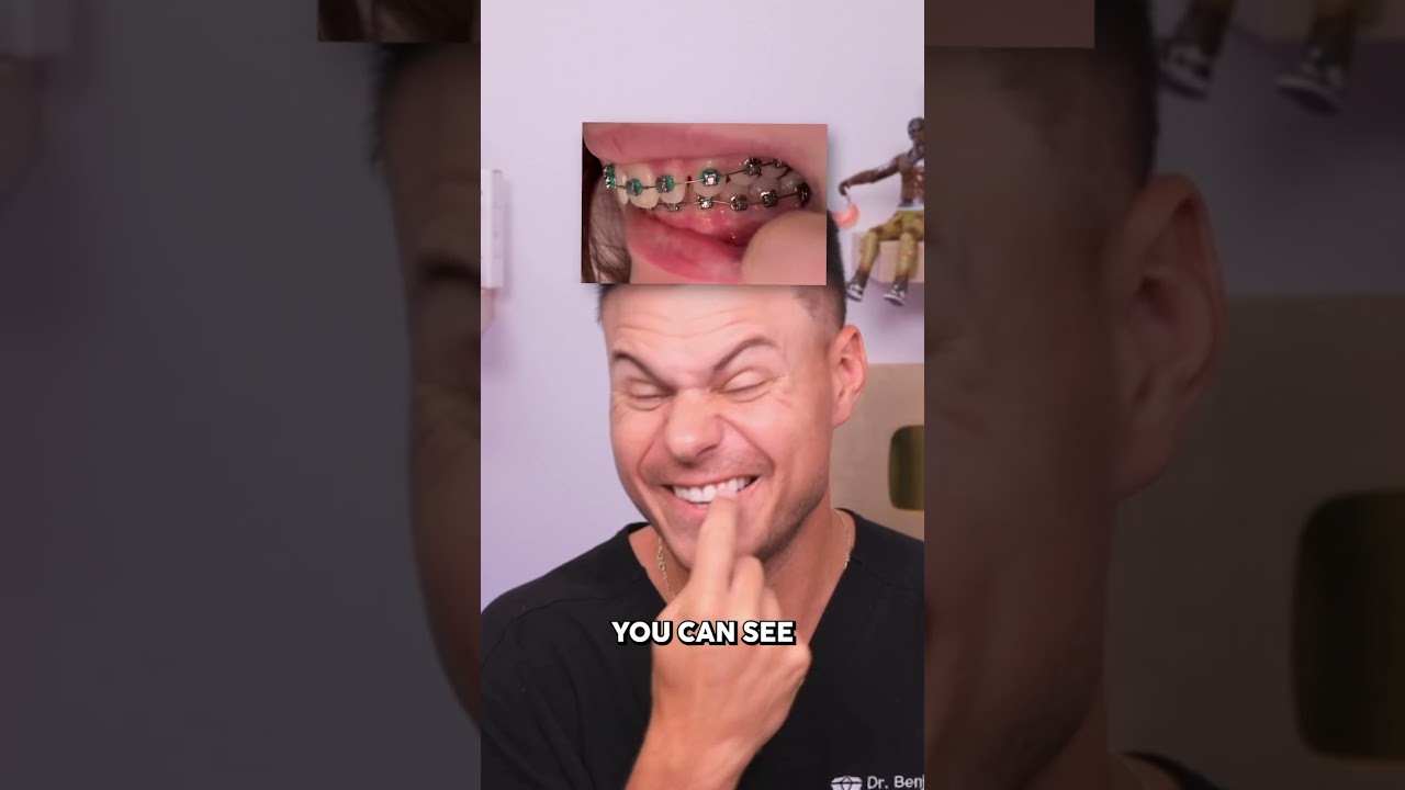 This Is What A Real OVERBITE Looks Like! 😮🦷