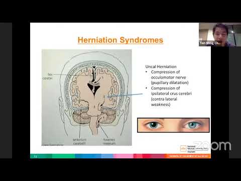 Principles of Intracranial Pressure Management