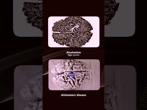 what chronic alcohol use does to the brain. #medical #quitdrinking #sober #neuroscience doctor