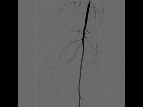 Right femoral artery angiography - DSA