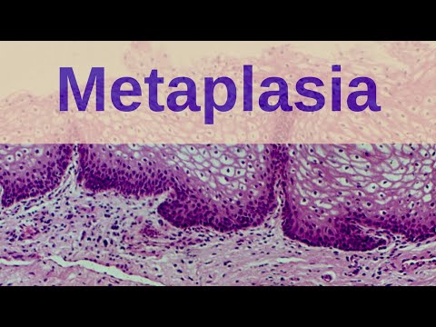 What is Metaplasia? - Pathology mini tutorial