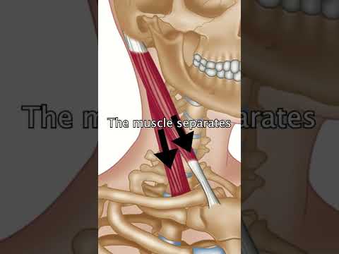 The Sternocleidomastoid Muscle