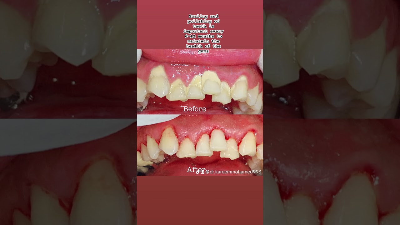 Removal of calculus deposits on teeth#cairo #dentist #dentalclinic #egypt