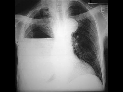 Medical Index - Update on Aspiration Pneumonia