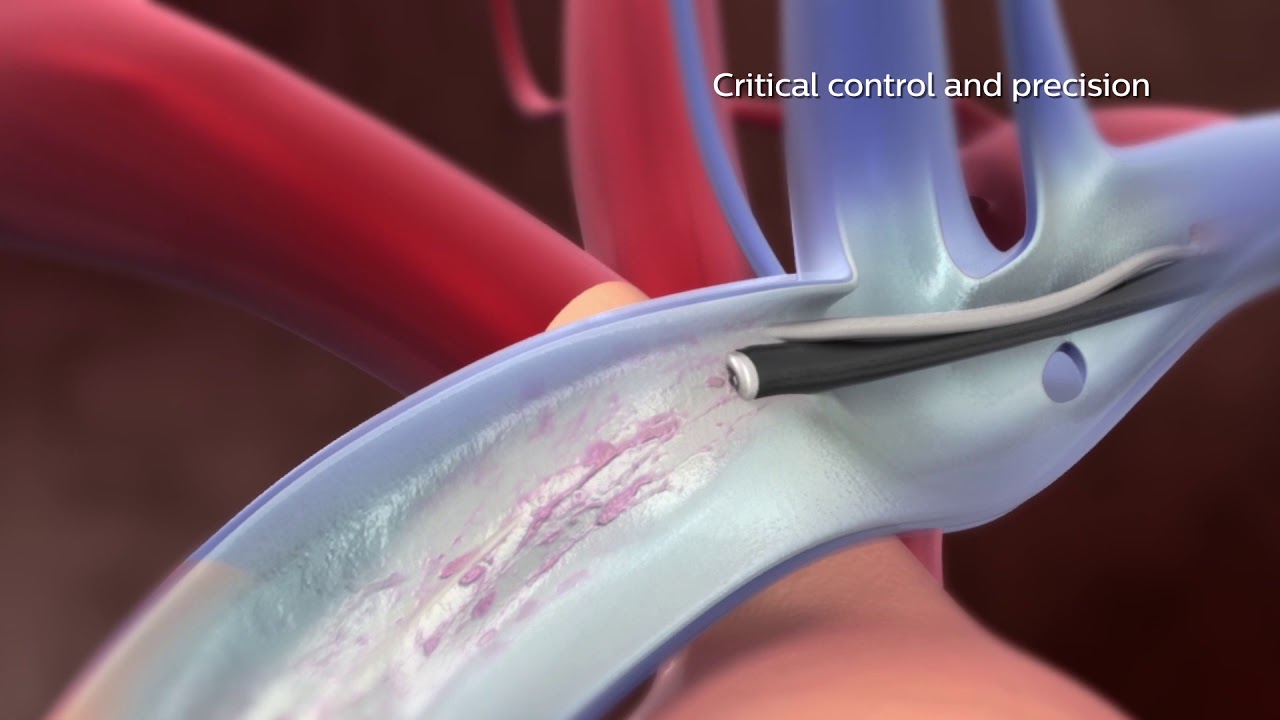 TightRail Rotating Dilator Sheath