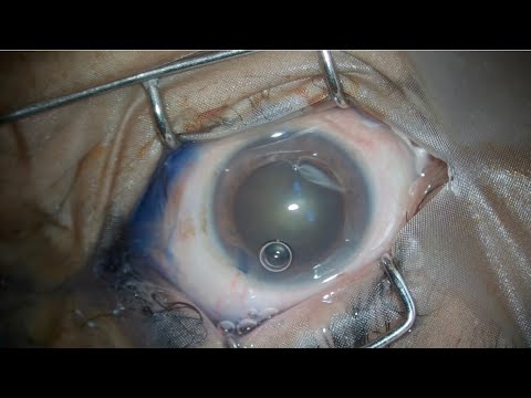 Posterior polar cataract with grade 3 nuclear sclerosis phacoemuslification
