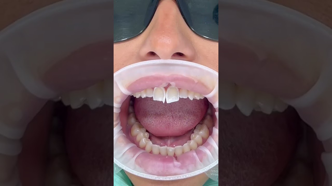 Composite bonding in action. 👏 #cosmeticdentistry #ruhdental