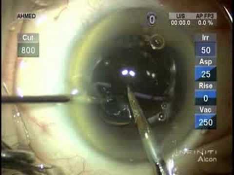 Explantation of calcified H60M intraocular lens