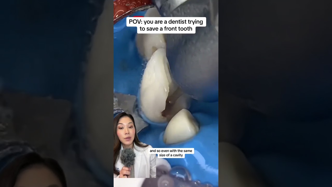 Trying to save a front 🦷 tooth with a large cavity. #dentist #dentistry #cavity #rootcanal