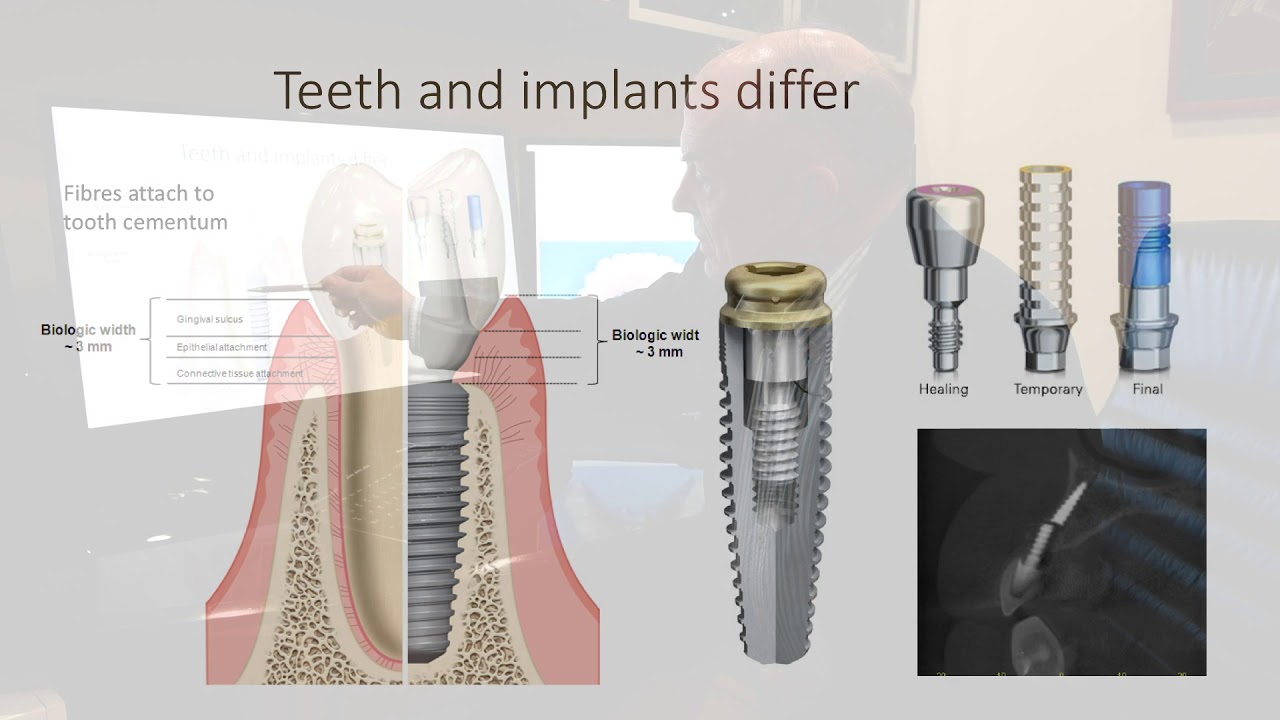 Dental Implants Introduction