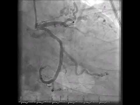 Coronary Angiogram with LAD Artery Stenosis