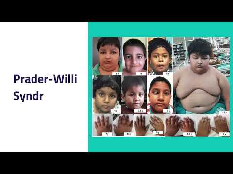 What is Prader Willi Syndrome | Dr. Jahanvi M | Pediatric Endocrinologist | Aster Hospital