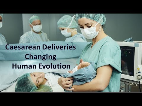 Cesarean Section Changes Human Evolution- Know About