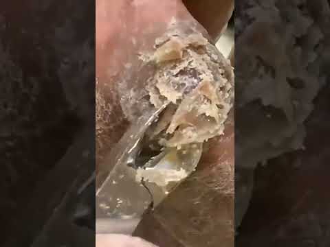 Diabetic Peripheral Neuropathy Can Lead To Thick Calluses