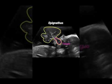Epignathus